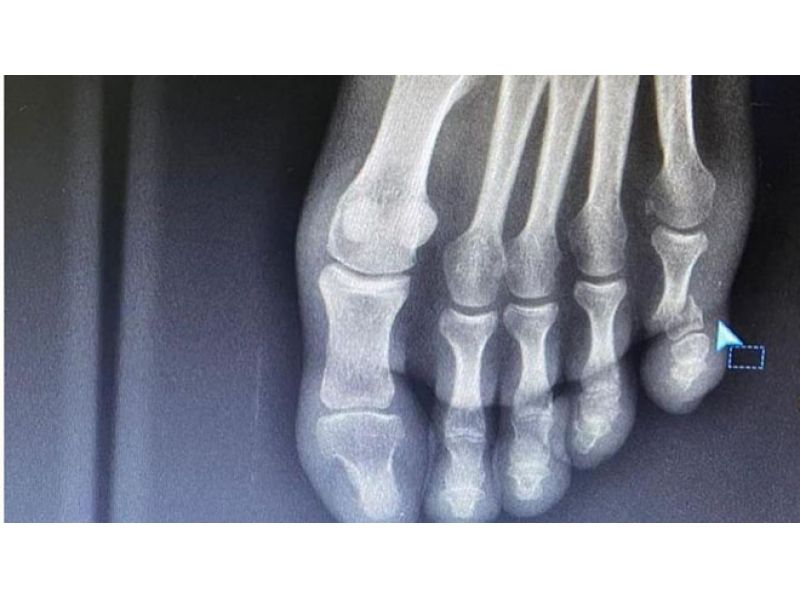 INCIDENTE DOMESTICO E MIGNOLO FRATTURATO PER RIGOBERTO URAN